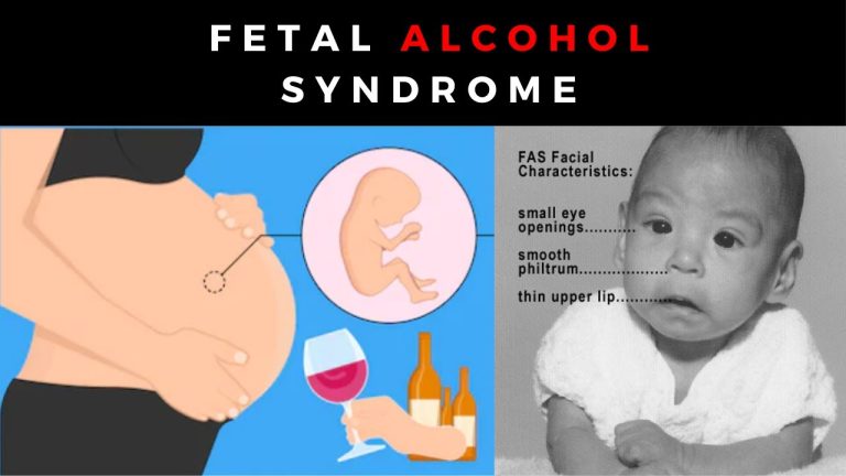 Fetal Alcohol Syndrome: How Alcohol Affects Babies