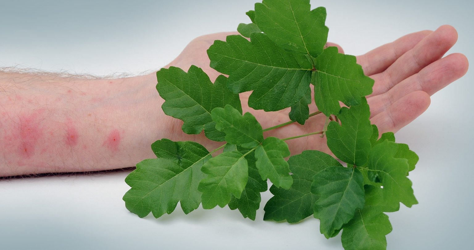 Understanding and Treating Atopic Dermatitis
