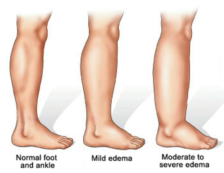 Navigating Edema: Unraveling Its Complexity and Solutions
