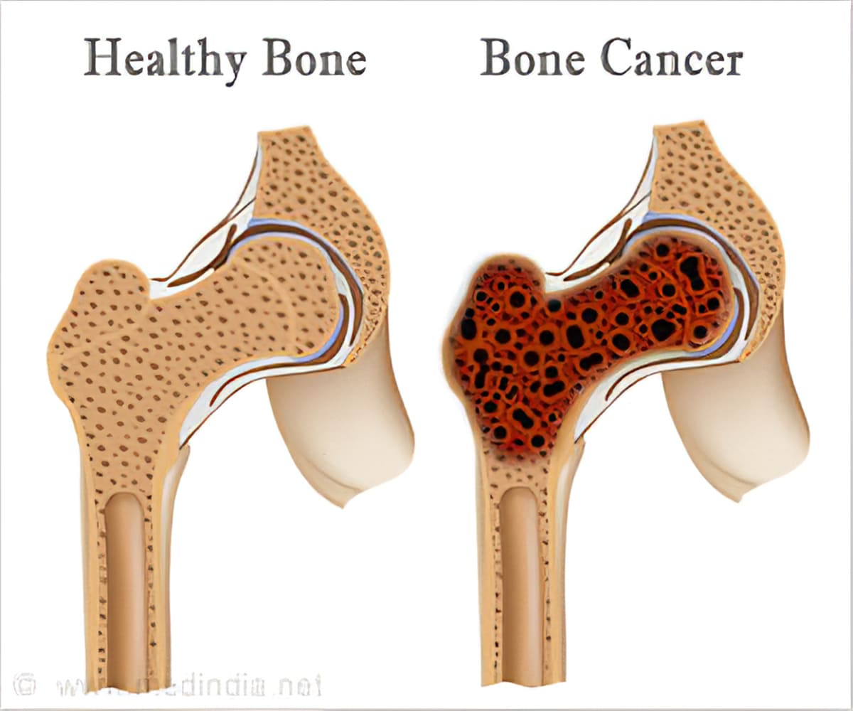 Understanding Stage 4 Bone Cancer: A Comprehensive Guide