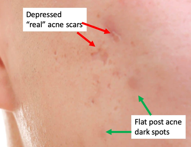 Can Plastic Surgery Helps With Acne Scars? - Pressmaverick