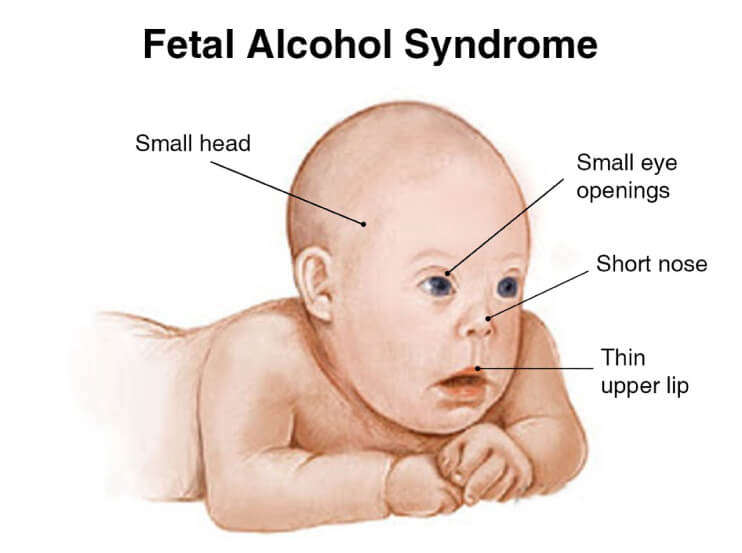 Fetal Alcohol Syndrome: How Alcohol Affects Babies